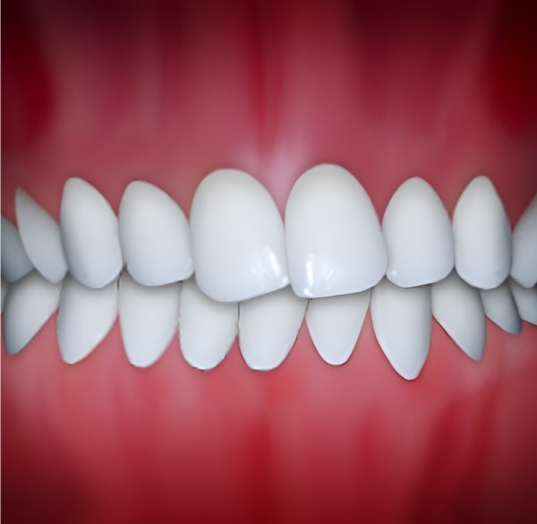 Common Orthodontic Problems | Greco Orthodontics Mercerville